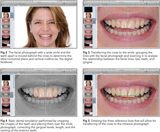 Digital Smile Design crack and license: A Tool for Treatment Planning ...