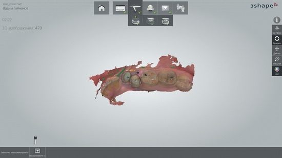 Model Builder crack from 3Shape – a simple way from a digital ...