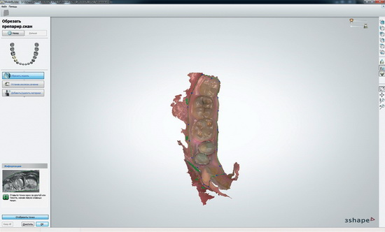 Model Builder crack from 3Shape – a simple way from a digital ...