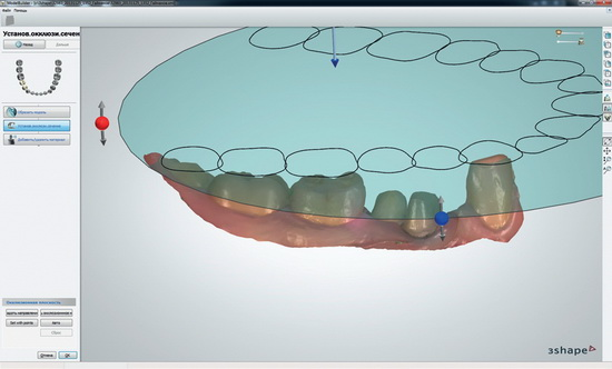 Model Builder crack from 3Shape – a simple way from a digital ...
