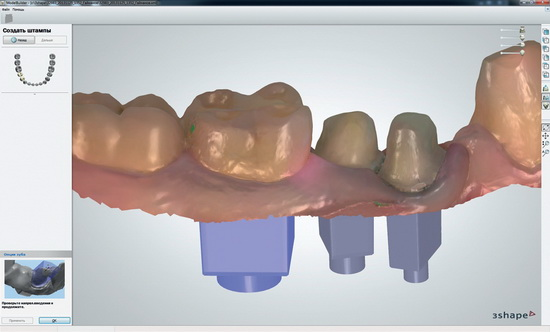 Model Builder crack from 3Shape – a simple way from a digital ...