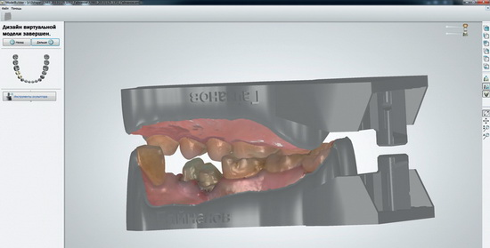 Model Builder crack from 3Shape – a simple way from a digital ...